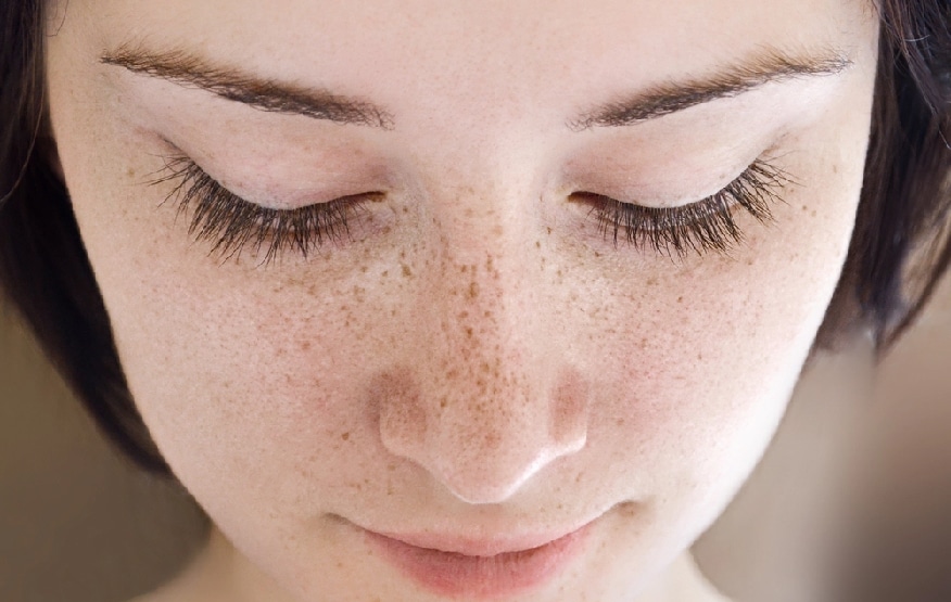 FLEk Hitam dan Bagaimana Cara Profesional menghilangkannya?