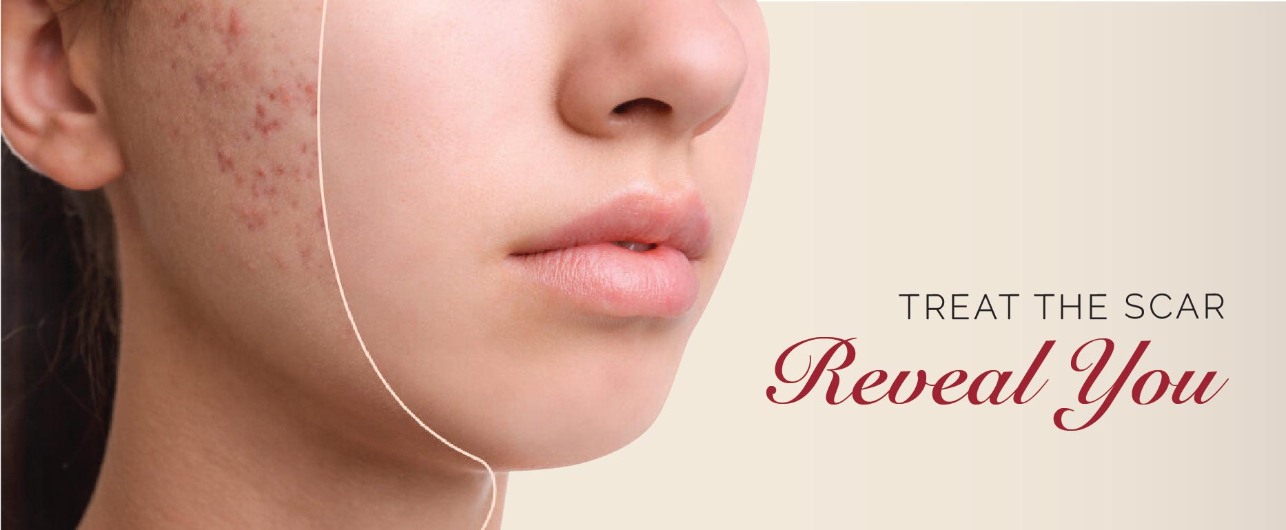 Scar Treatment - Beauty Plus Clinic
